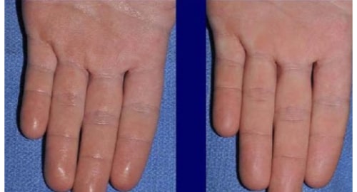 Hyperhidrosis | Chennai | Derma Med Spa The Skin Clinic